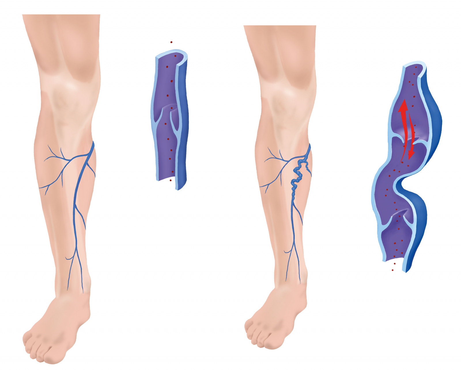 Ontstaan van spataders - Heelkunde tielt