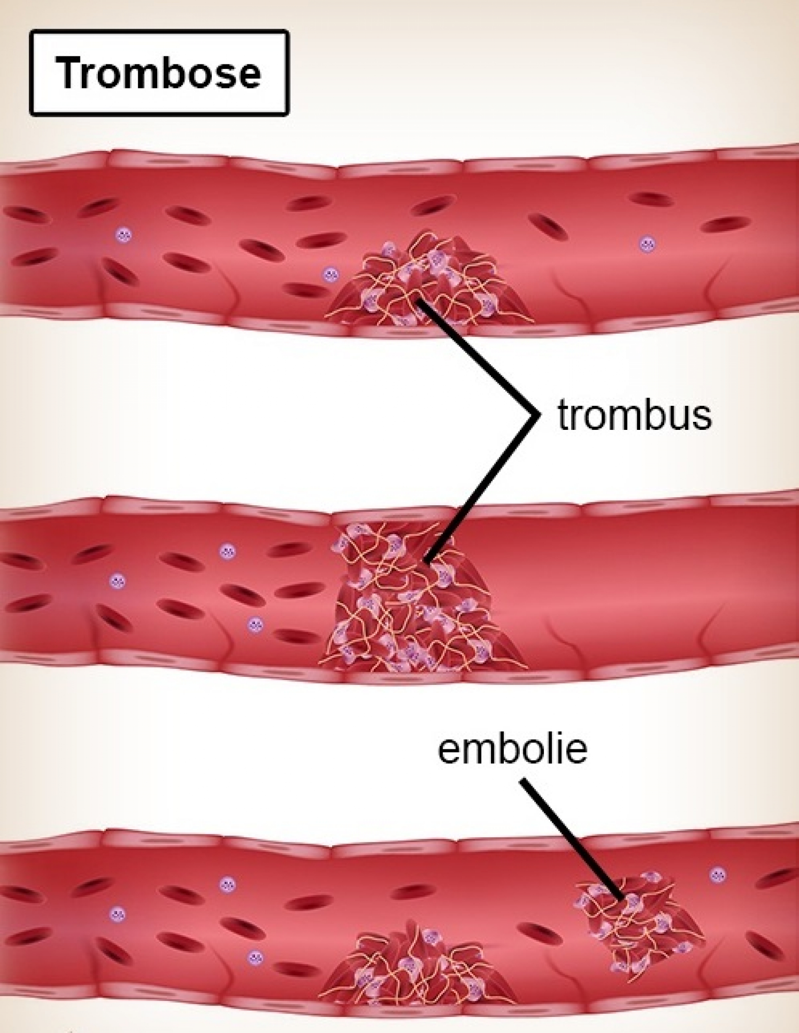 Slagaderverkalking of atherosclerose - Heelkunde tielt