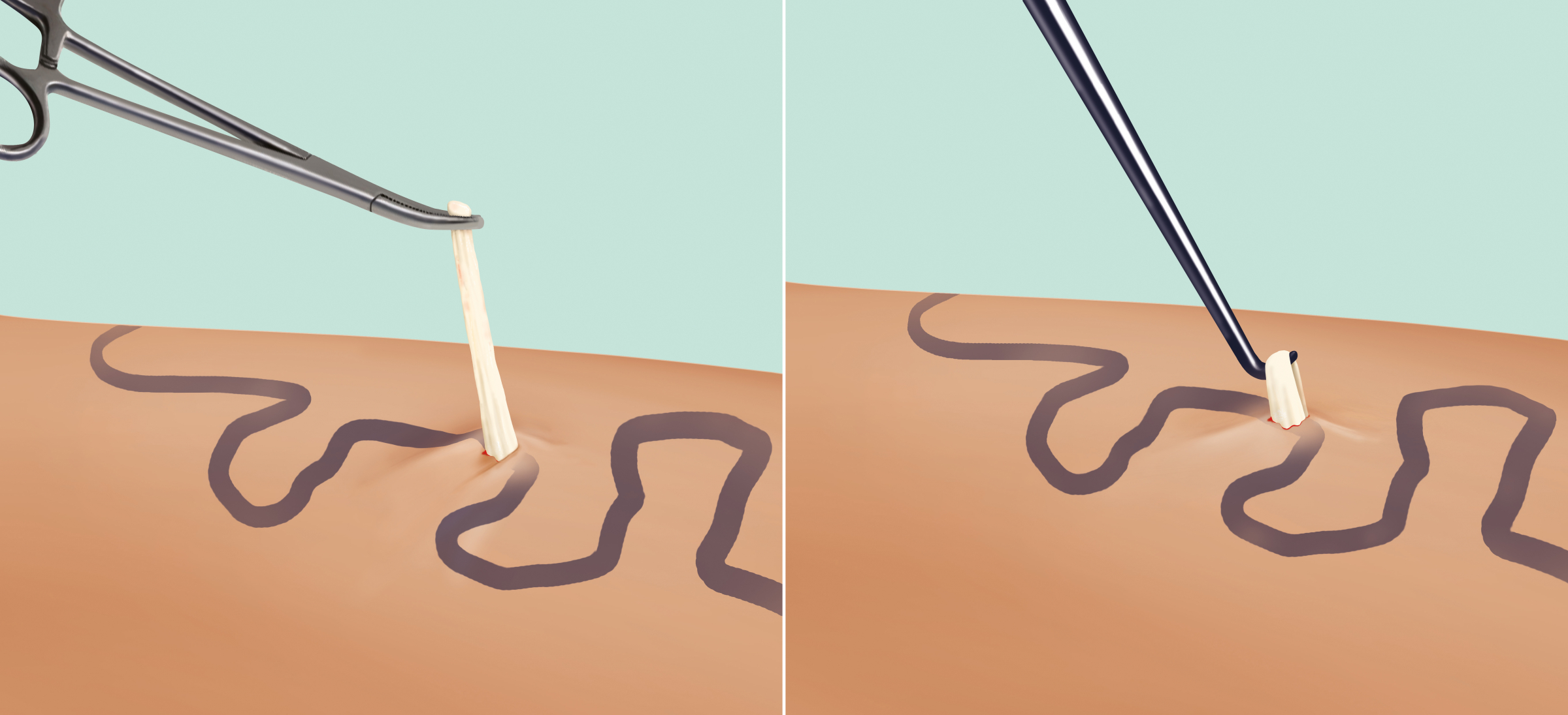 Endoveneuze spataderbehandelingen - Heelkunde tielt