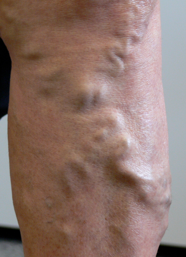 Wat zijn spataders? - Heelkunde tielt