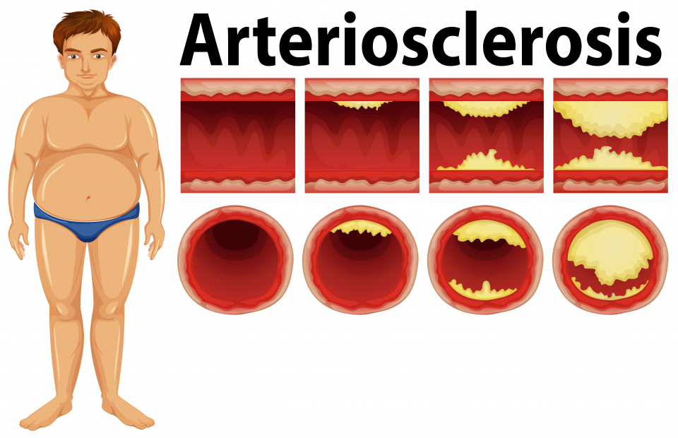 Slagaderverkalking of atherosclerose - Heelkunde tielt