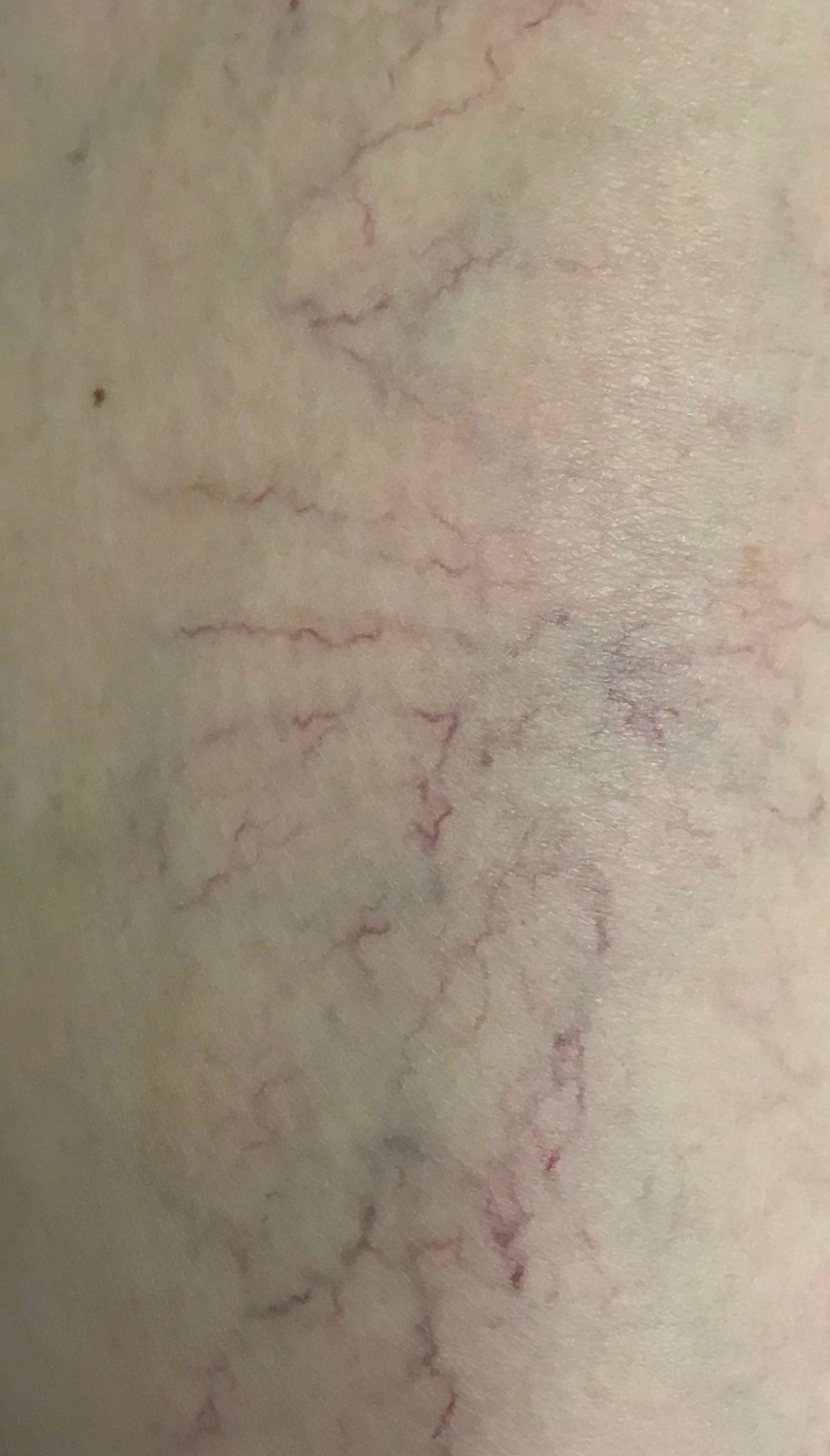 Ontstaan van spataders - Heelkunde tielt